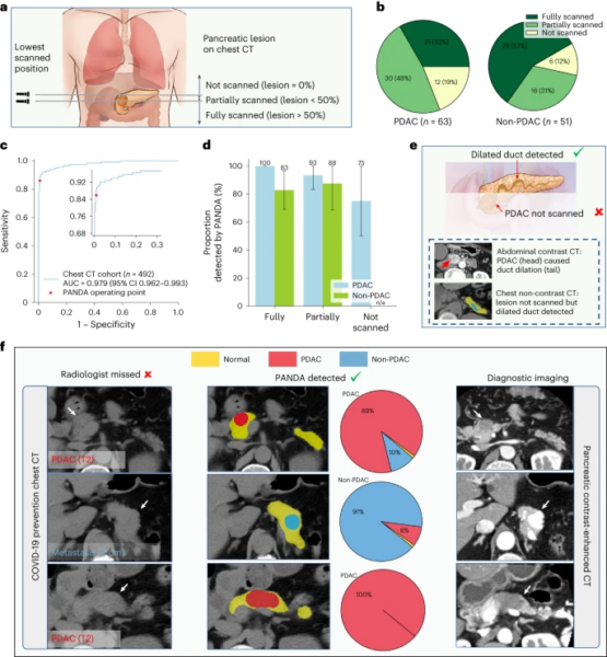 在 2 万病例中识别出 31 例漏诊，阿里达摩院牵头发布「平扫 CT +大模型」筛查胰腺癌 / 资讯 / HyperAI超神经 | HyperAI超神经