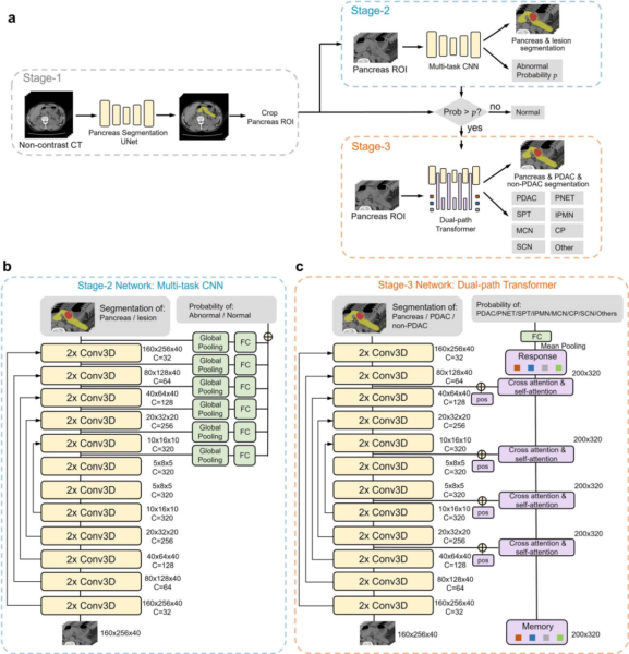 在 2 万病例中识别出 31 例漏诊，阿里达摩院牵头发布「平扫 CT +大模型」筛查胰腺癌 / 资讯 / HyperAI超神经