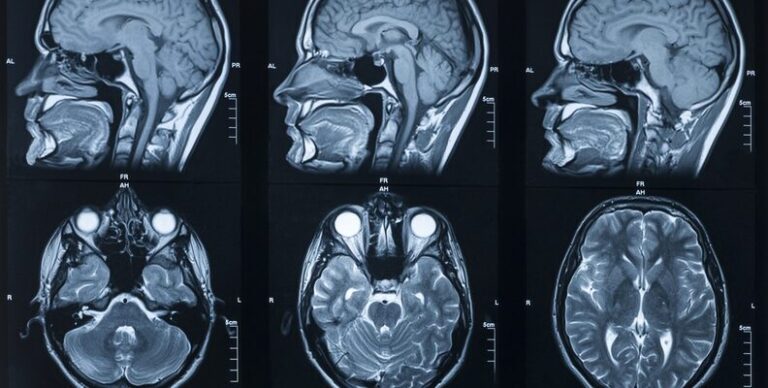 Brain Tumor Dataset 脑肿瘤医学数据集 | 数据集 | HyperAI超神经